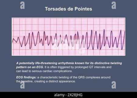 ECG displaying Torsades de pointes rhythm, illustration Stock Photo - Alamy