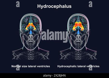 Enlarged and normal lateral ventricles, illustration Stock Photo - Alamy