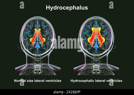 Enlarged and normal lateral ventricles, illustration Stock Photo - Alamy