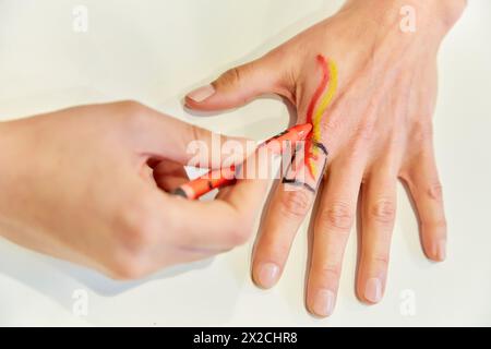 Hand. Flap. Hand surgery. In reconstructive surgery tips, flaps is one ...