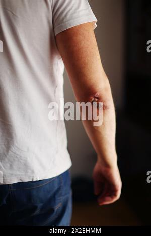 skin burn in the healing stage on the log Stock Photo - Alamy