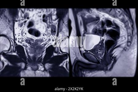 MRI of the prostate gland reveals a focal abnormal signal intensity (SI ...