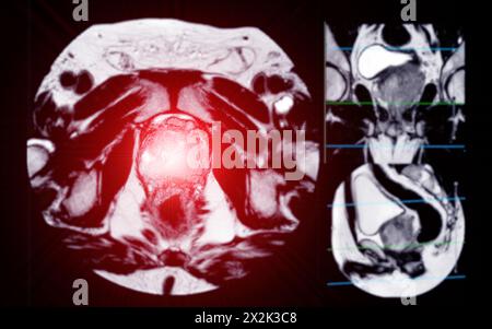 MRI of the prostate gland reveals Focal abnormal SI lesion at left PZpl ...