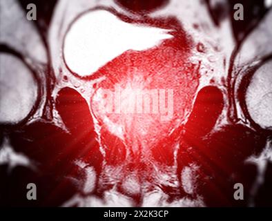 MRI of the prostate gland reveals a focal abnormal signal intensity (SI ...