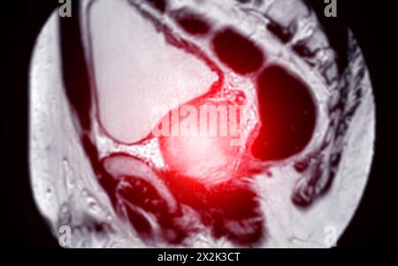 MRI of the prostate gland reveals Focal abnormal SI lesion at left PZpl ...