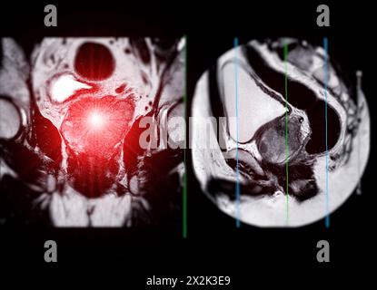 MRI of the prostate gland reveals Focal abnormal SI lesion at left PZpl ...