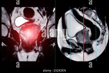 MRI of the prostate gland reveals a focal abnormal signal intensity (SI ...