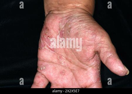 ringworm between fingers