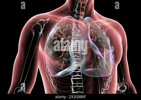 Illustration depicting lungs affected by silicosis within a transparent ...