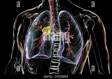 Illustration of primary lung tuberculosis, featuring the Ghon complex ...