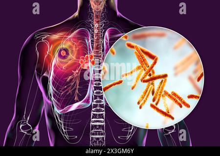 Illustration of primary lung tuberculosis, featuring the Ghon complex ...