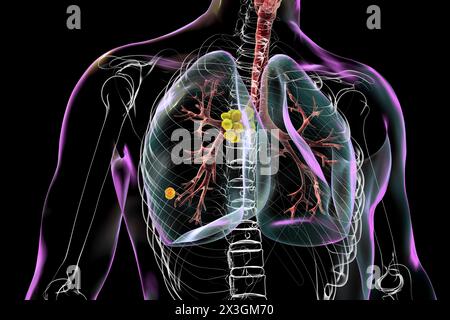 Illustration of primary lung tuberculosis, featuring the Ghon complex ...