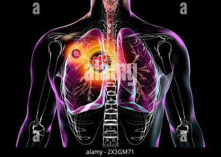 Illustration of primary lung tuberculosis, featuring the Ghon complex ...