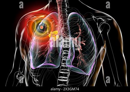 Illustration of primary lung tuberculosis, featuring the Ghon complex ...