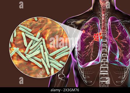 Illustration of primary lung tuberculosis, featuring the Ghon complex ...