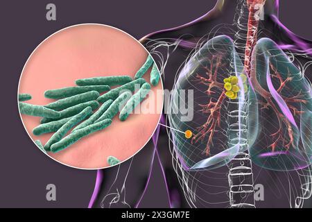 Illustration of primary lung tuberculosis, featuring the Ghon complex ...