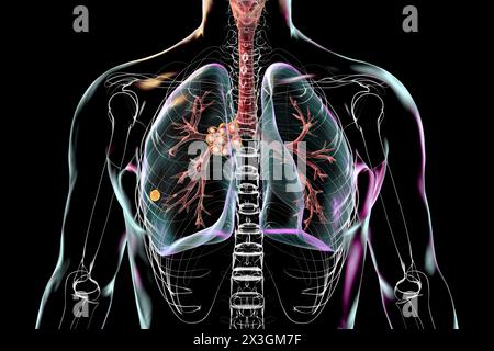 Illustration of primary lung tuberculosis with the Ranke complex ...