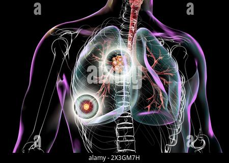 Illustration of primary lung tuberculosis with the Ranke complex ...