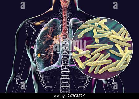Illustration of primary lung tuberculosis with the Ranke complex ...