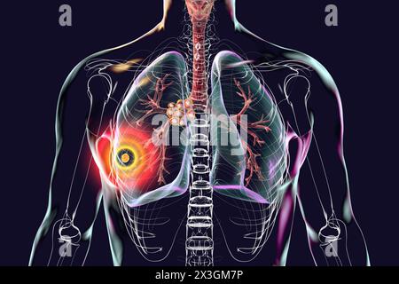 Illustration of primary lung tuberculosis with the Ranke complex ...