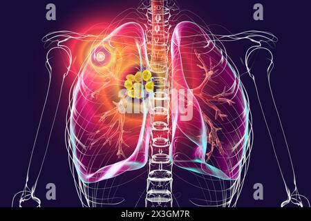 Illustration of primary lung tuberculosis, featuring the Ghon complex ...