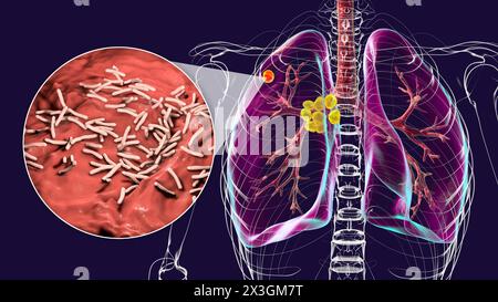 Illustration of primary lung tuberculosis, featuring the Ghon complex ...