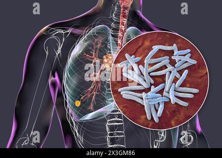 Illustration of primary lung tuberculosis with the Ranke complex ...