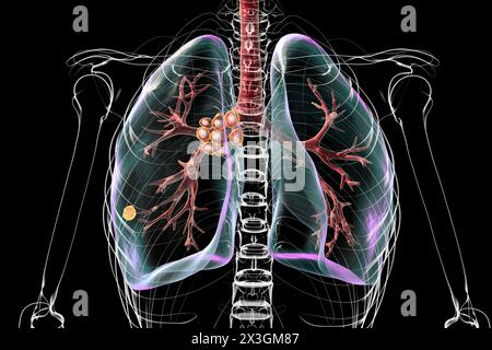 Illustration of primary lung tuberculosis with the Ranke complex ...