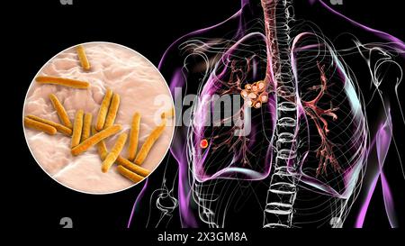 Illustration of primary lung tuberculosis with the Ranke complex ...