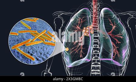Illustration of primary lung tuberculosis with the Ranke complex ...