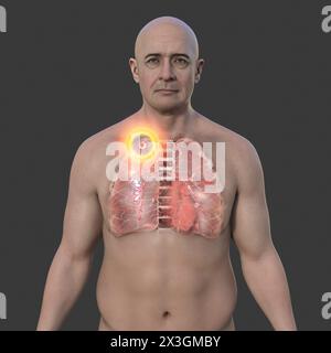 Illustration of a man with lungs affected by secondary tuberculosis and ...