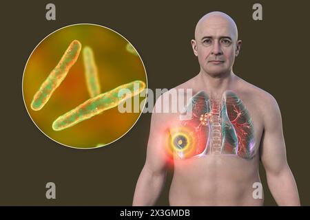 Illustration of a man with primary lung tuberculosis, revealing the ...
