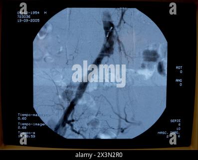 Angiography, implantation of stent or coronary endoprosthesis ...