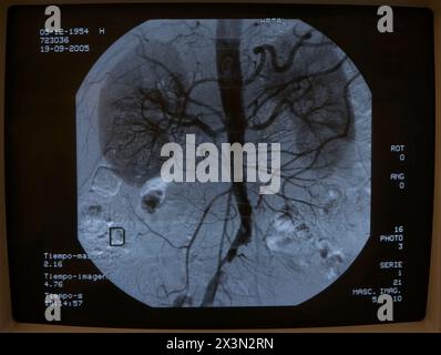 Angiography, implantation of stent or coronary endoprosthesis ...