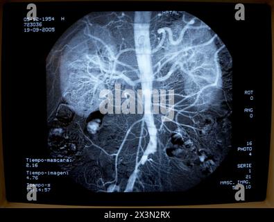 Angiography, implantation of stent or coronary endoprosthesis ...