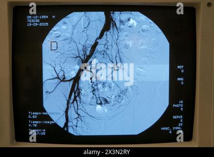Angiography, implantation of stent or coronary endoprosthesis ...