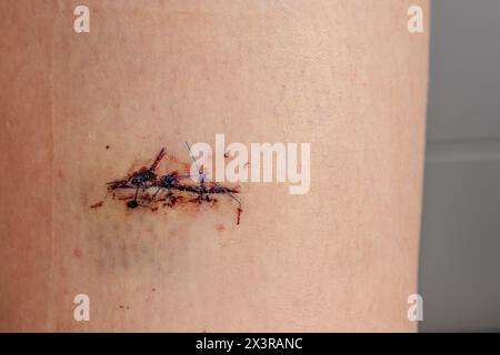 Medical sutures, stitch after surgery, stitched surgical sutures on ...
