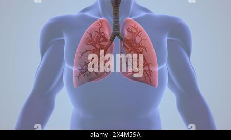 Human Pleurisy Lung Inflammation Pain Stock Photo - Alamy
