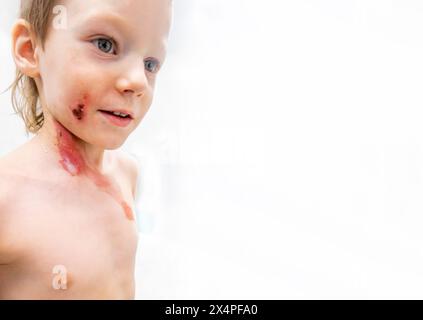 dressing a boy with a burn from boiling water Stock Photo - Alamy