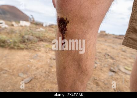 Man's leg injury, wound and blood. Selective focus. People Stock Photo ...