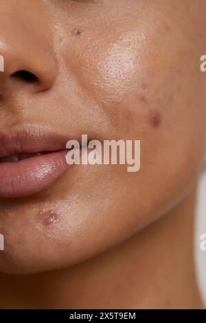 Close up shot of acne on skin Stock Photo - Alamy