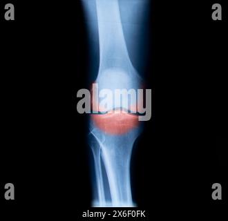 X-ray of an elderly person with osteoporosis and arthritis arthrosis ...