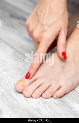 woman examining the horn on her big toe. nail fungus. toenail disease ...