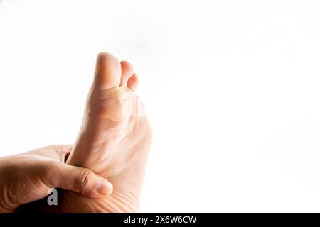 Skin peeling off a foot Stock Photo - Alamy