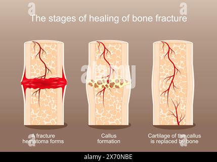 Stages Of Healing Bone Fracture. Formation of callus. The bone fracture. Infographics. Vector ...