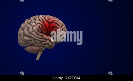 Brain bleed or an intracranial Hemorrhage Stock Photo - Alamy