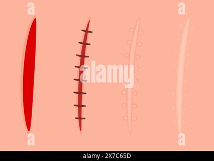 surgery suture cartoon vector illustration Stock Vector Image & Art - Alamy