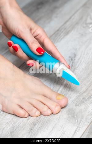 woman sanding her toenails with a sander. nail fungus. toenail disease ...