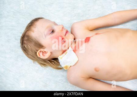 medical procedure dressing a boy with a first-degree burn from boiling ...