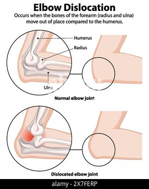 Comparison of normal and dislocated elbow joints Stock Vector Image & Art - Alamy